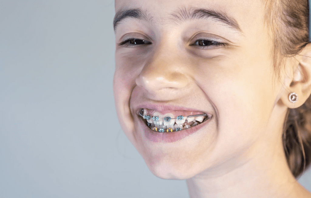 A Guide To The Different Types Of Braces Available For Children - Sly ...